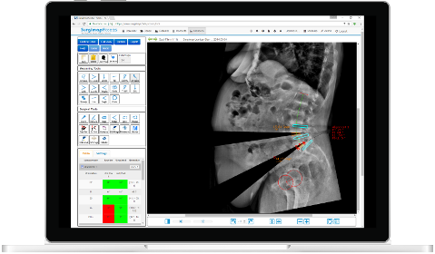 Scoliosis Research Society - Surgimap.com: Official Site for Surgimap